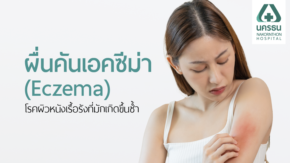 โรคผื่นภูมิแพ้ผิวหนังชนิดเอคซิม่า (Eczema) กับการรักษาให้ถูกวิธี | รพ. ...